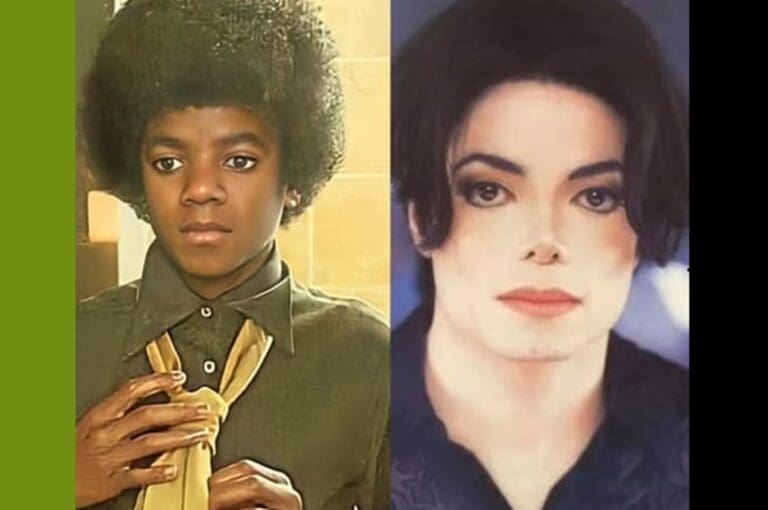 Michael Jackson Did Not Bleach His Skin To Appear White - Vitiligo